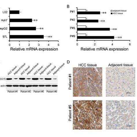 Isg Is Highly Expressed In Hcc Cells And Tissues The Mrna Expression