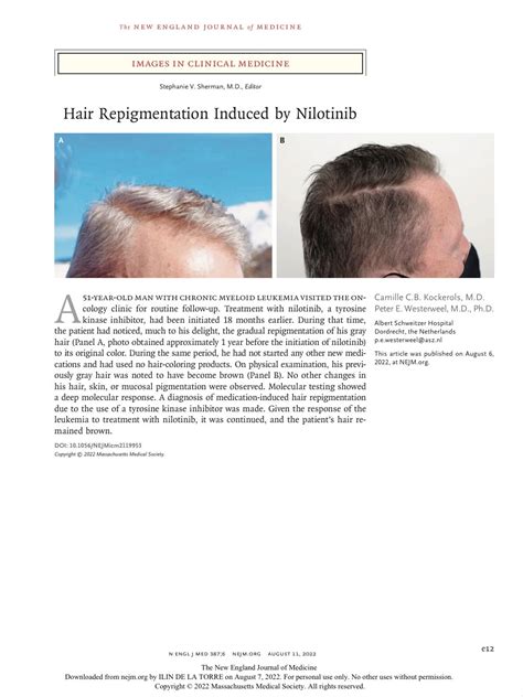 Dr Ilin Gilberto De La Torre M On Twitter Repigmentaci N Capilar
