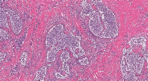 Atypical Parathyroid Adenoma Atlas Of Pathology