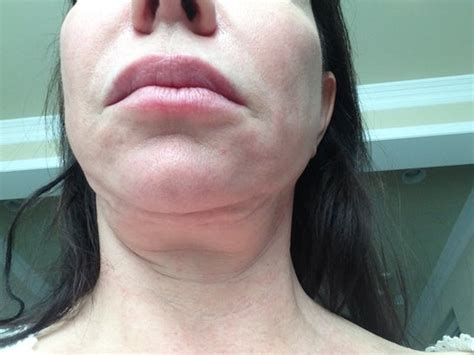 Swollen Salivary Glands In Neck