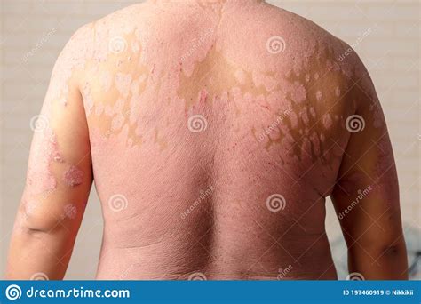 Krankheiten Verursacht Durch Abweichungen Der Lymphe Psoriasis Ist