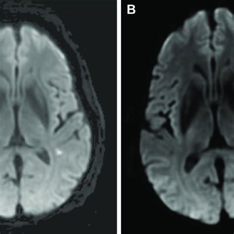 Fig A Preoperative Diffusion Weighted Magnetic Resonance Imaging