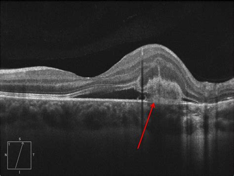 Degeneraci N Macular Asociada A La Edad
