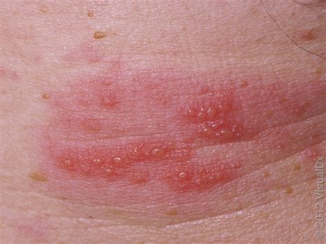 Is It Possible To Get Shingles If You Never Had Chickenpox Goodrx