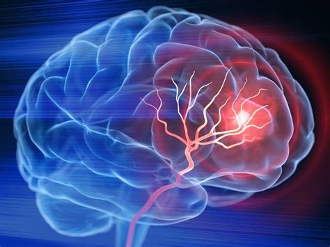 Qué es un ictus cuáles son sus síntomas y cómo prevenirlo Ocio y