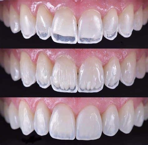 Lente de Contato Dental Antes e Depois Atende Já Odontologia