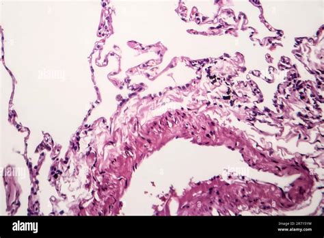 Histopathologie De L Emphys Me Pulmonaire Micrographe L Ger Photo