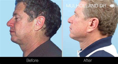 Tumescent Liposuction Patient Spamedica