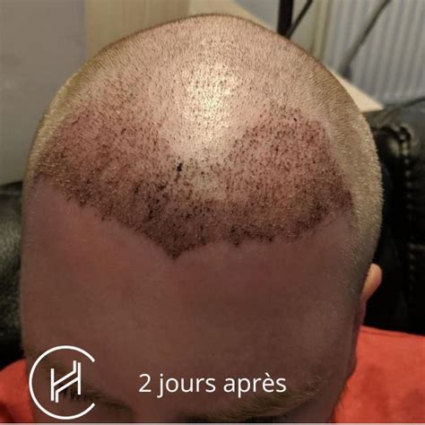 Greffe de cheveux évolution mois par mois 0 14 mois photos