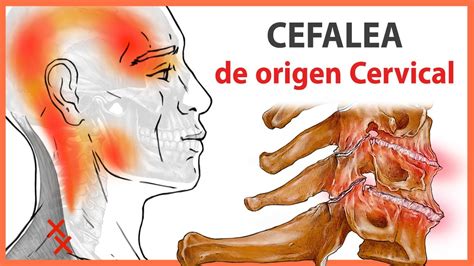 CLAVES de la CEFALEA Dolor de Cabeza de ORIGEN CERVICAL Qué es y