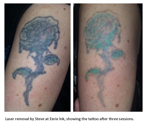 Cómo quitar un tatuaje con láser