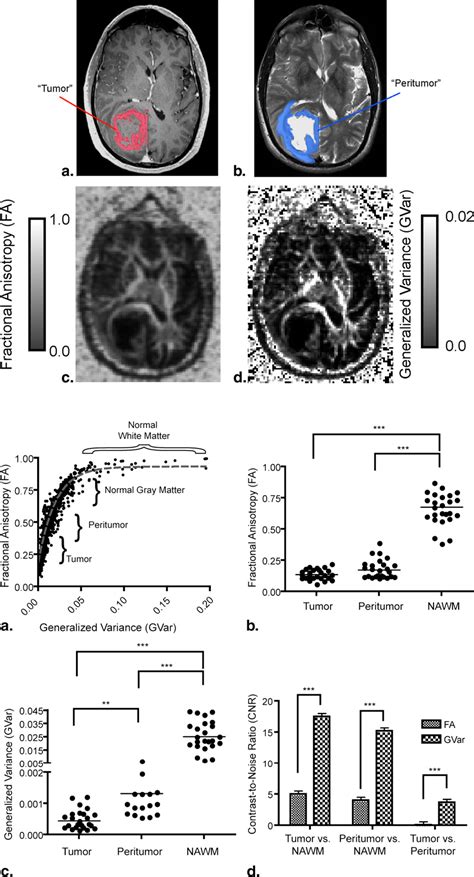 figure 1 from high order diffusion tensor imaging in human glioblastoma semantic scholar