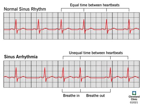 Ecg Normal Sinus Rhythm Infographic Diagram Stock I Almuhja