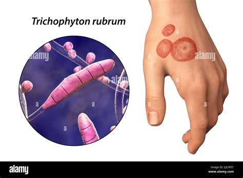 Trichophyton Rubrum Hi Res Stock Photography And Images Alamy