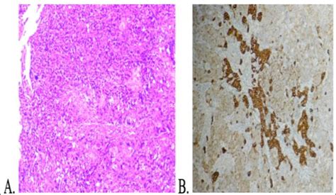 Histologic Feature Of The Biopsy Tissue A Hematoxylin Eosin Staining