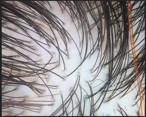 Androgenetic Alopecia And Teloqen Effluvium Dual Diagnoses Common