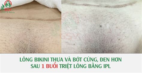 Rất Hay Cách triệt lông bằng mỡ trăn tại nhà