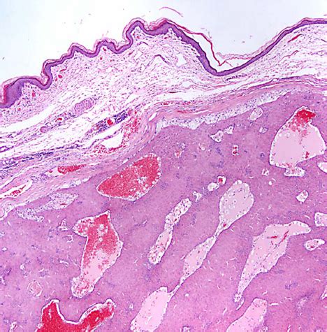Pathology Neoplasia Flashcards Quizlet
