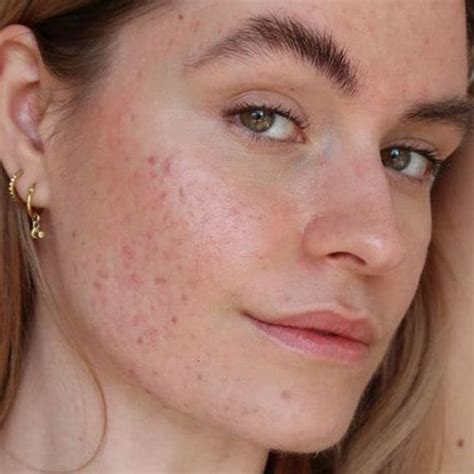 Cicatriz De Acne Como Se Forma Quais Os Tratamentos
