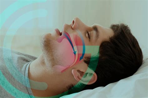 Apneia Do Sono Riscos Sintomas E Tratamento Dr Gabriel Campolongo