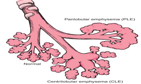 Week 10 Asthma COPD Flashcards Quizlet