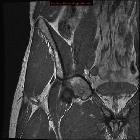 Hip MRI Coronal 4 Diagram Quizlet