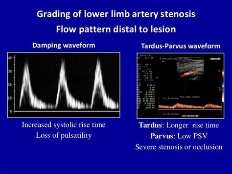 Lower Extremity Arterial Doppler Velocities