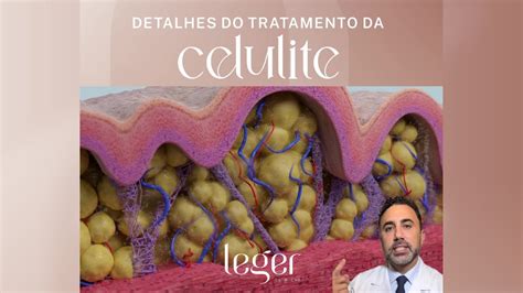 Dr Roberto Chacur Explica O Tratamento Da Celulite Goldincision