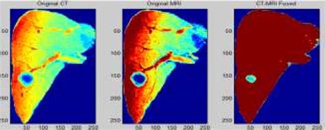figure 1 from medical image fusion using redundant wavelet based ica co variance analysis