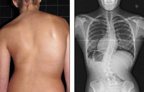 Qué es la escoliosis Causas síntomas diagnóstico y tratamiento
