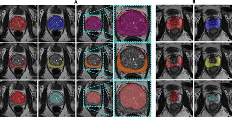figure 2 from automatic prostate and prostate zones segmentation of magnetic resonance images