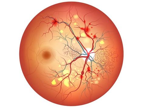 Retinopat A Diab Tica Qu Es S Ntomas Causas Y Tratamiento Natursan