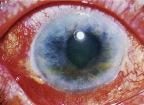 CLIN MED EXAM 3 Vision Loss Flashcards Quizlet