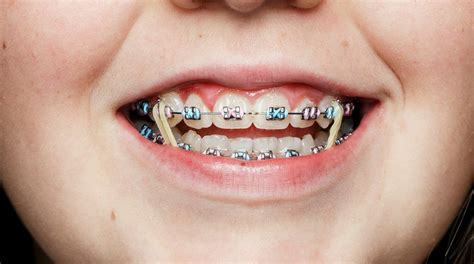 What Are Elastic Bands For Braces How To Put Elastic Rubber Bands On
