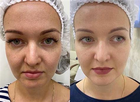 Carbon Laser Peel In London Revitalise Your Skin