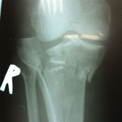 Broken Leg Bone X Ray