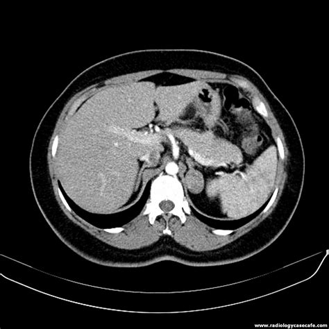 Abdomen Radiology Case Cafe