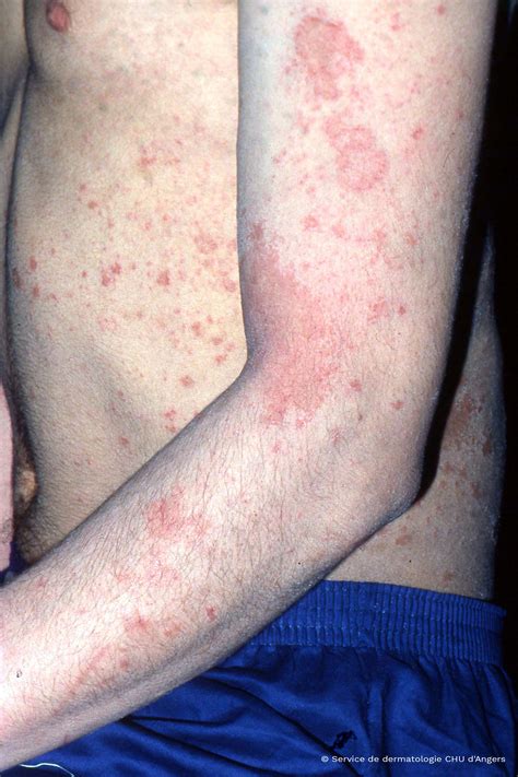 Atopic Dermatitis In Adults Pictures Photos