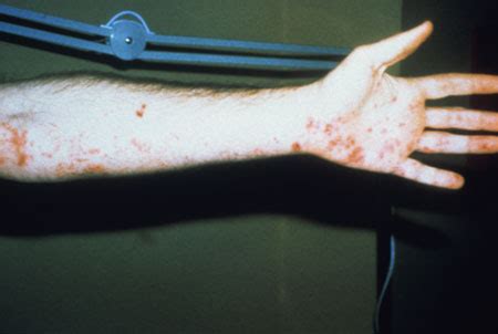 VA Clinical Public Health Programs HIV AIDS Herpes Simplex Viruses