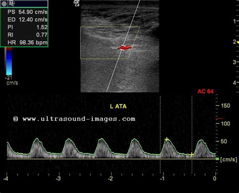 Lower Extremity Arterial Doppler Radiology