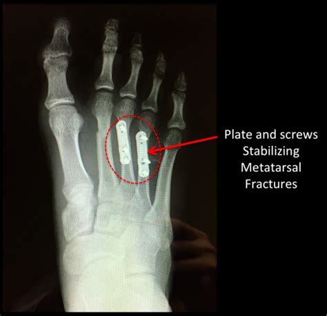 Mexico Kilimanjaro Automático metatarsal fracture healing time Sur