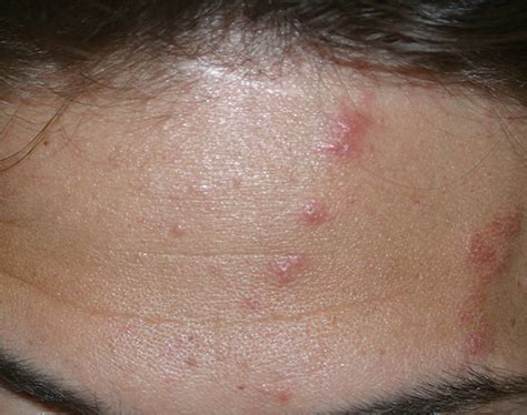 Varicella Shingles Vzv School Of Medicine