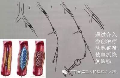 下肢动脉硬化闭塞症及介入微创血管腔内手术治疗视频