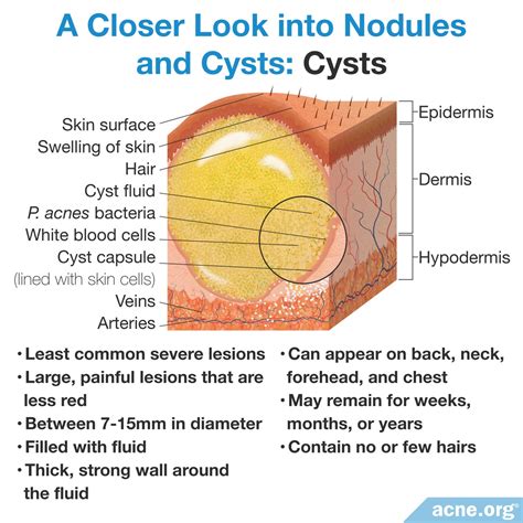 What Is Cystic Acne Acne Org