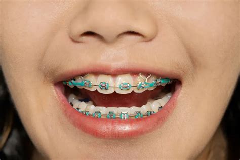 Elastics For Braces Everything You Need To Know Dr Whitlock