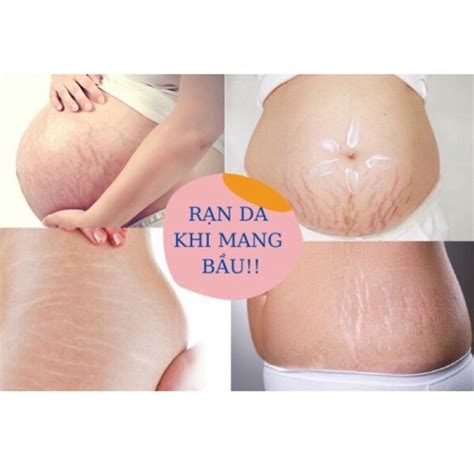 Kem chống rạn da cho bà bầu Pigeon chống rạn bụng đùi mông ngực cho bà