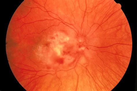 Retinitis Tipos Síntomas Causas Tratamiento La Salud Ocular 2024