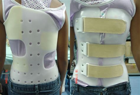 Scoliosis Brace
