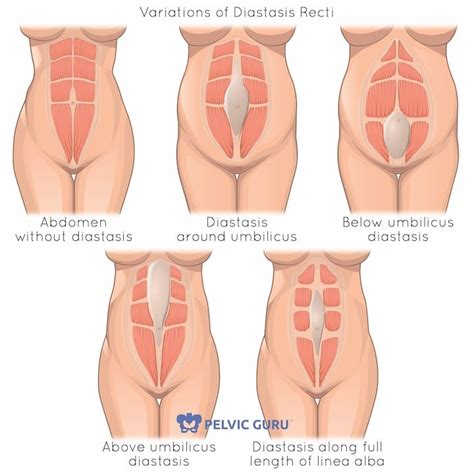 Diastasis Recti What It Is Why It S A Problem What You Can Do