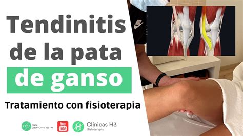 TENDINITIS de la pata de ganso RODILLA Qué tratamientos existen